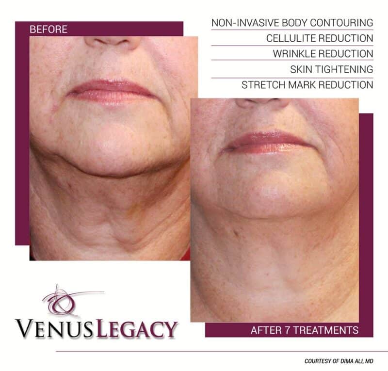 Venus Legacy นวด RF หลังดูดไขมัน กระชับผิว ลดผิวคลื่น ผิวย้วย กำจัดเซล ...